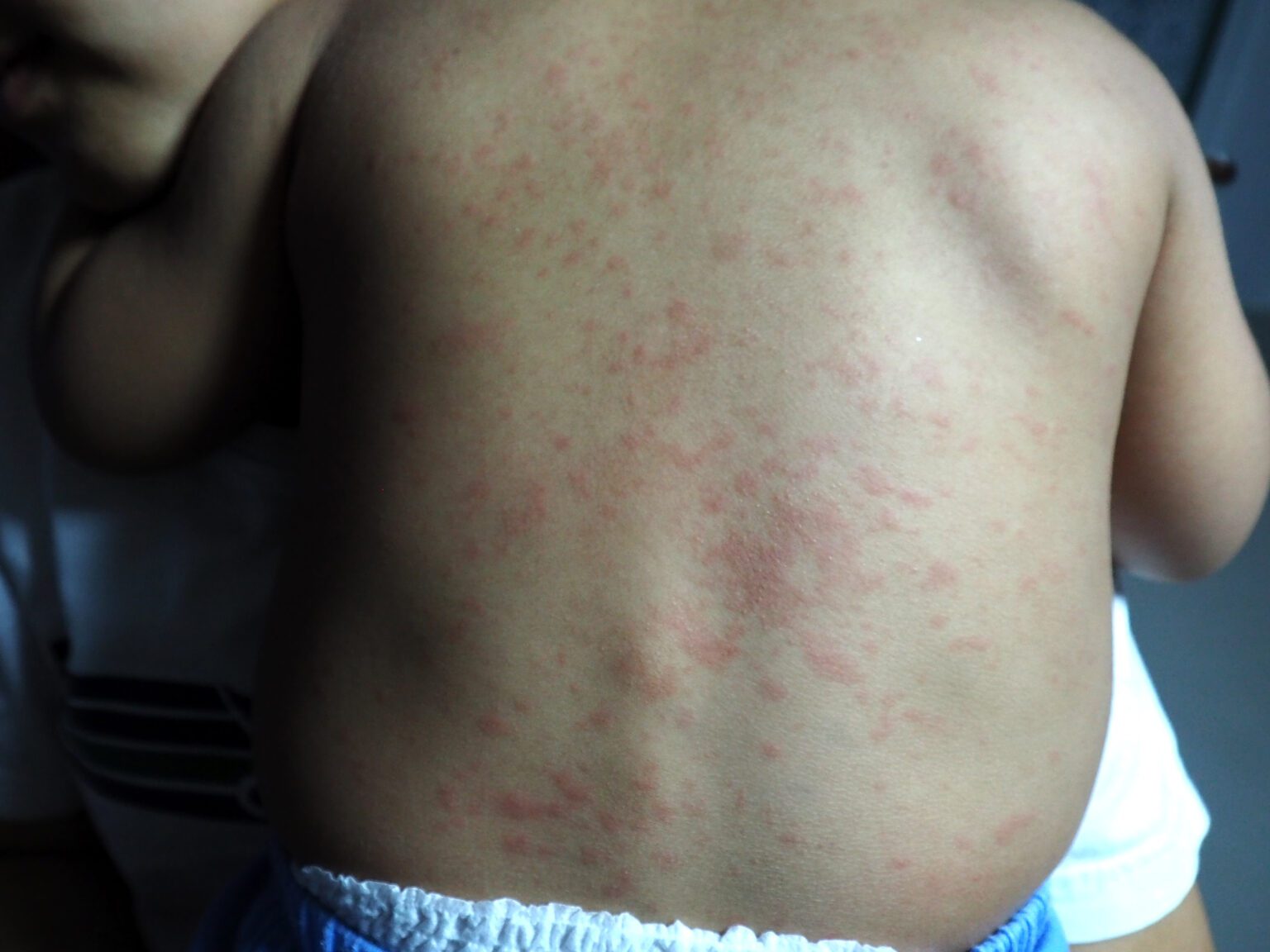 How do you treat baby back rash? - Trusted Advice