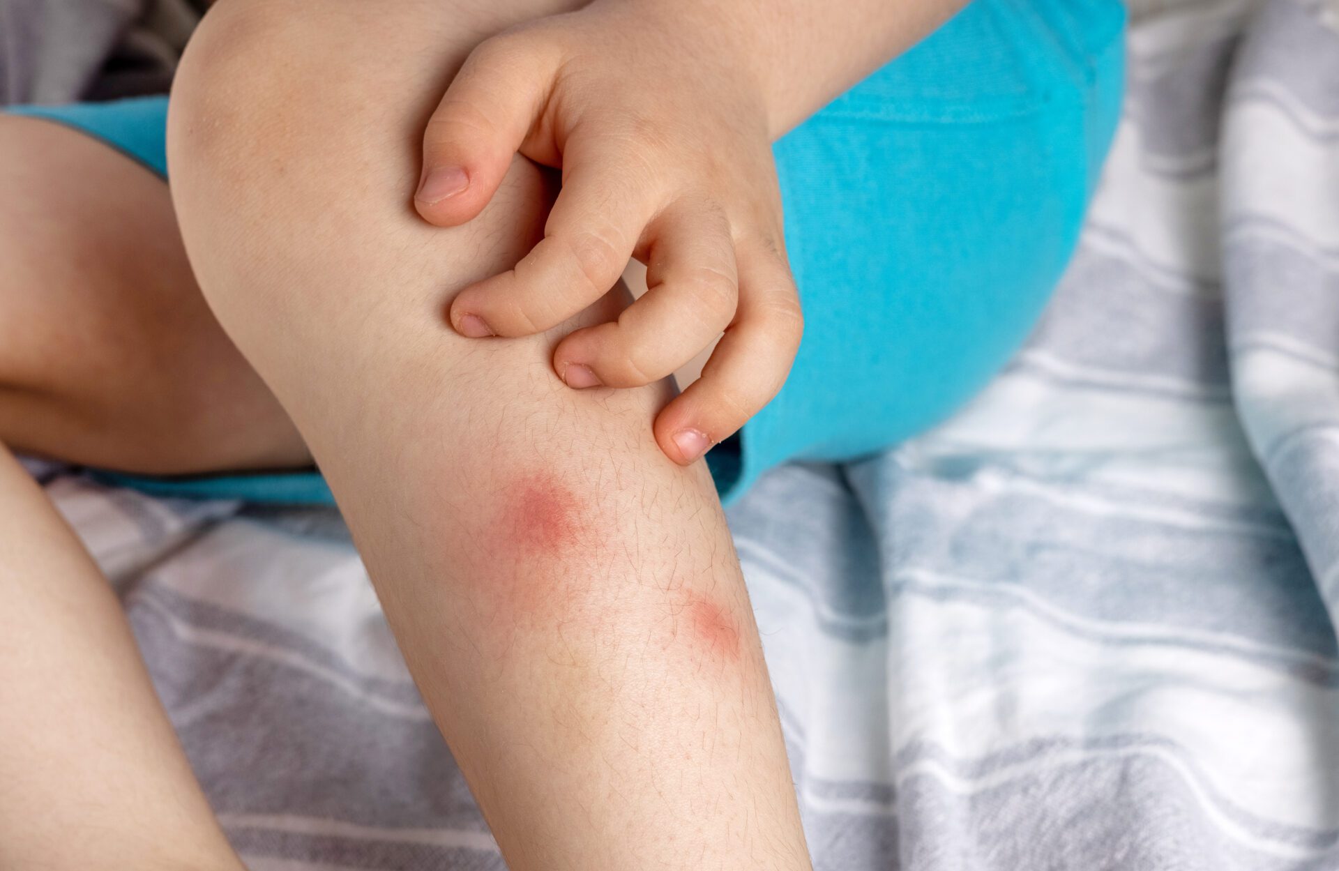 Understanding Eczema Rash in Babies - BLDG Active