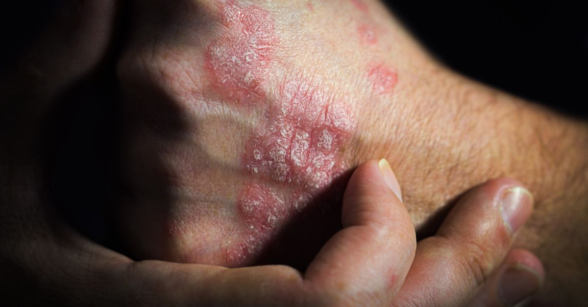 Contact Dermatitis Insights: Triggers and Relief - BLDG Active