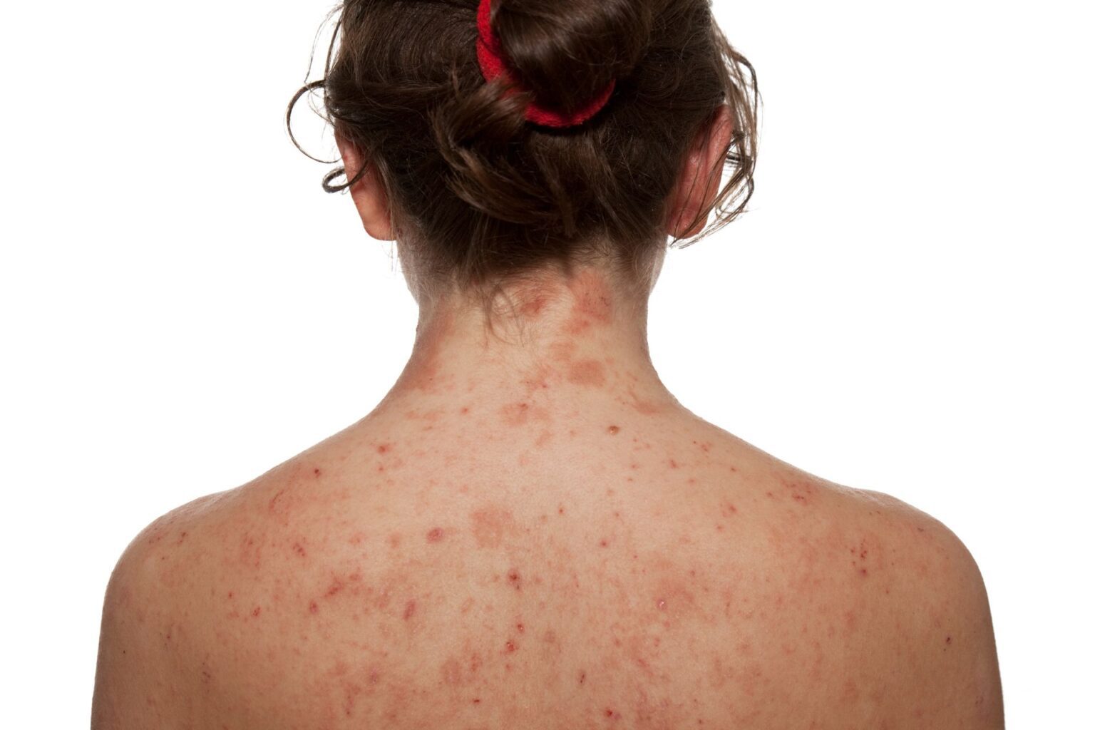 Delving into Hailey-Hailey Disease: From Genetics to Triggers - BLDG Active